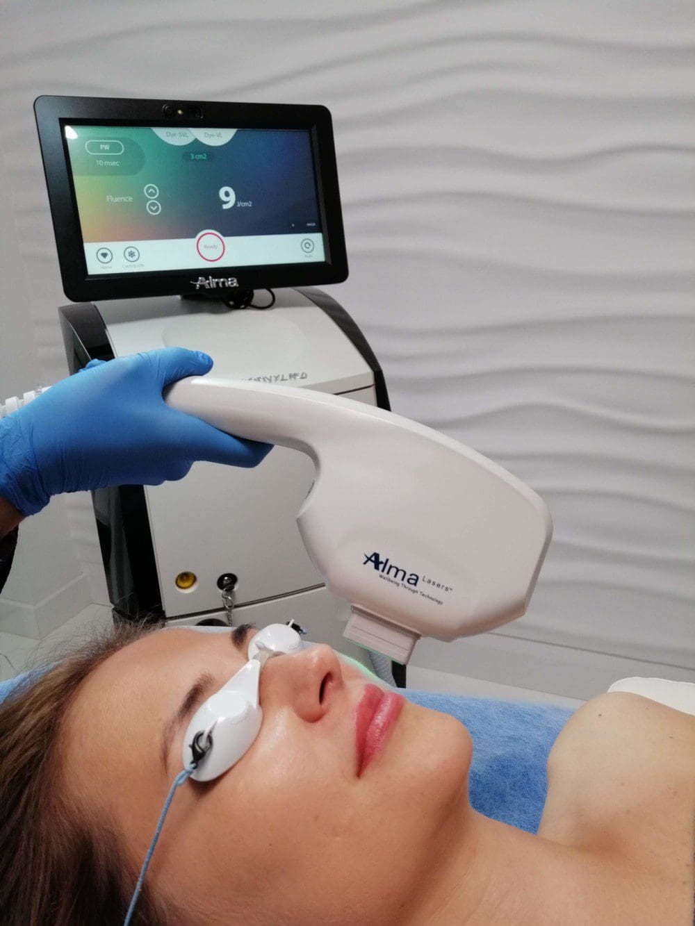 Broken capillaries removal, broken blood vessels closure Krakow